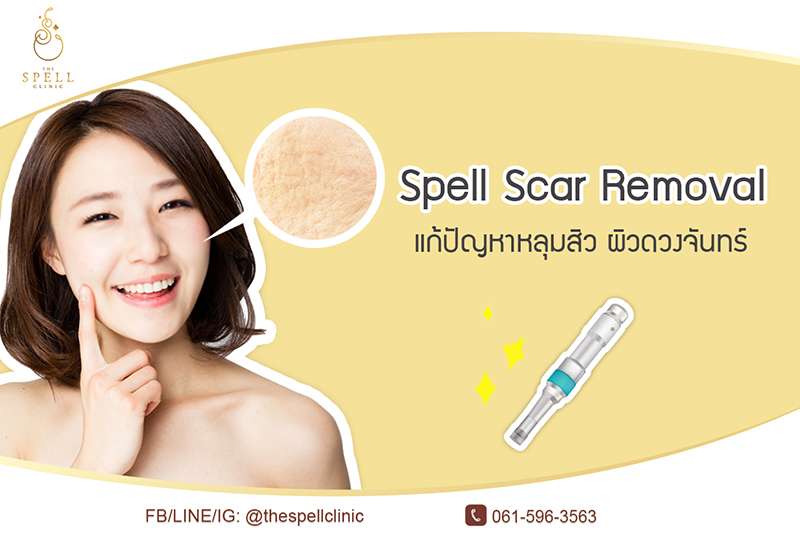 รักษาหลุมสิว Spell Scar Removal | The Spell Clinic